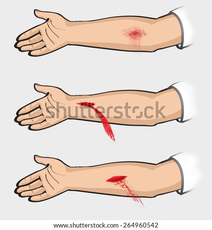 Bleeding Types Bleeding Classification Classification Bleeding Stock ...