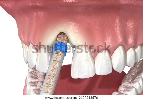 Bone Grafting Augmentation Socket Preservation Tooth: ภาพประกอบสต็อก ...