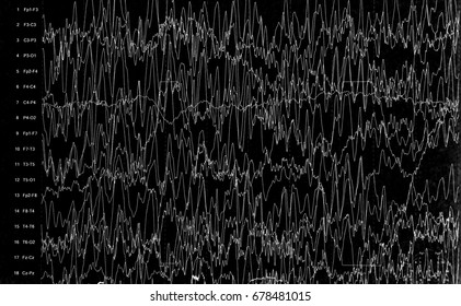 Abnormal Eegbrain Wave On Electroencephalogram Eeg Stock Photo (Edit ...
