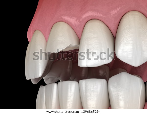 Broken Central Incisor Tooth Medically Accurate Stock Illustration ...
