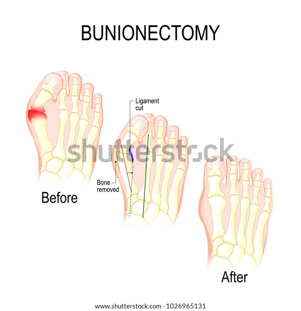Bunionectomy Procedure Correct Pathologies Deformity Joint ...