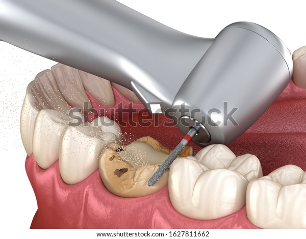 Caries Removing Process Medically Accurate Tooth Stock Illustration ...
