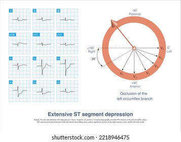 99 St Segment Depression Images, Stock Photos & Vectors | Shutterstock