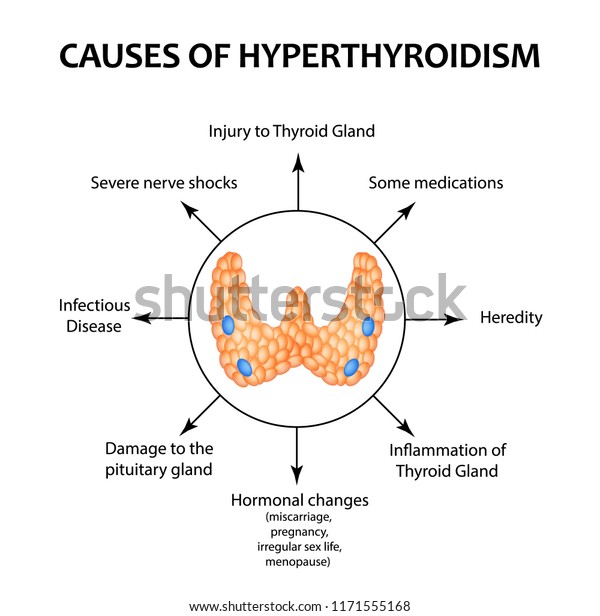 Ilustrasi Stok Causes Hyperthyroidism Thyroid Gland Infographics ...