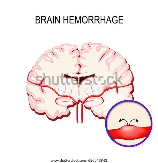 Cerebral Hemorrhage Stroke Bleeding Inside Human Stock Illustration ...