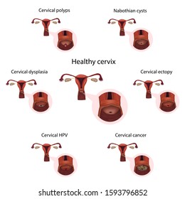Cervical Diseases Cervix Polyps Ectopy Dysplasia: стоковая иллюстрация ...