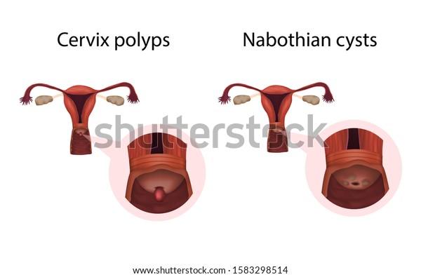 Cervix Polyps Nabothian Cysts Cervical Disease 스톡 일러스트 1583298514 ...