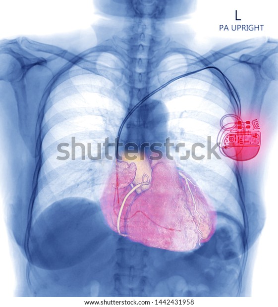 Chest X-ray or X-Ray Image Of Human Chest with pacemaker placement or ...