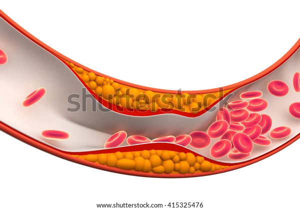 Cholesterol Plaque Artery3d Render Stock Illustration 415325476