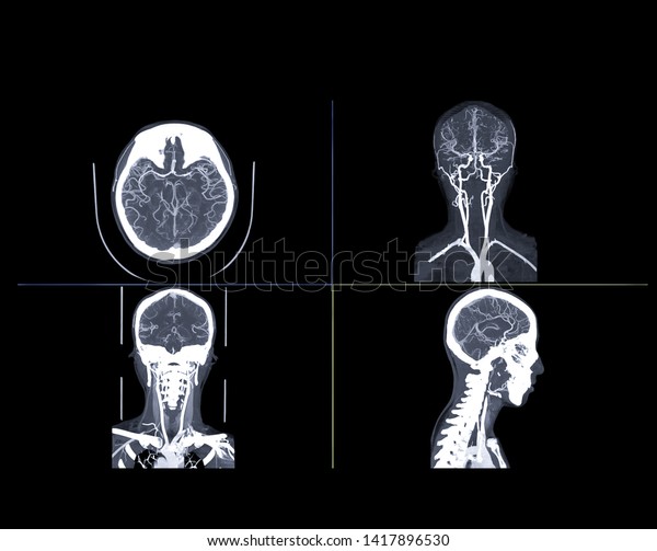 Collection Cta Brain Ct Angiography Brain Stock Illustration 1417896530 ... Collection Cta Brain Ct Angiography Brain Stock Illustration 1417896530 ...