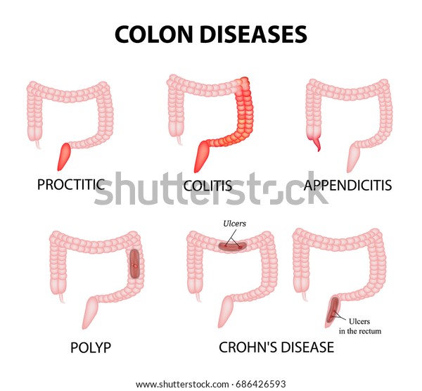 Colon Diseases Proctitis Colitis Appendicitis Polyp Stock Illustration ...
