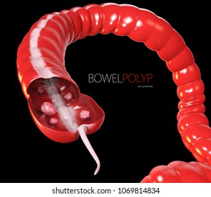 Colon Polyps 3d Illustration Polyp Intestine Stock Illustration ...