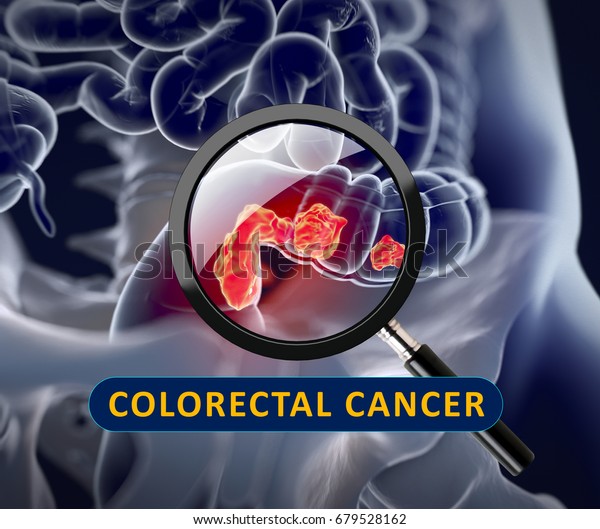 Colorectal Cancermedical Anatomical Illustration3d Illustration Stock