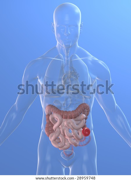 Colostomy Stock Illustration 28959748