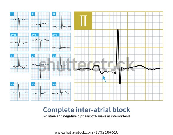 Complete Interatrial Block Left Atrium Activated Stock Illustration ...