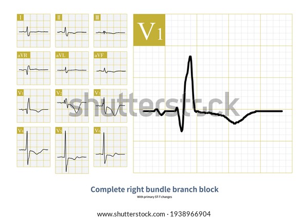 Complete Right Bundle Branch Block Primary Stock Illustration ...
