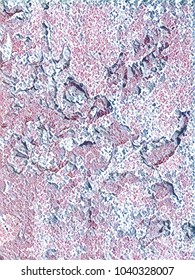 Adenolymphoma Tumor Under Microscope Stock Photo (Edit Now) 1054973015
