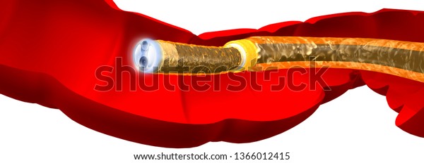Cross Section Colon Scope Colonoscope Colon Stock Illustration ...
