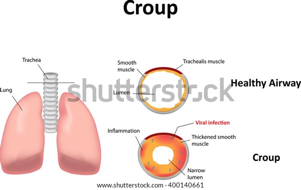 Croup Stock Illustration 400140661