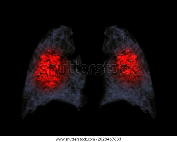 Ct Chest 3d Rendering Showing Lung Stock Illustration 2028467633 ...