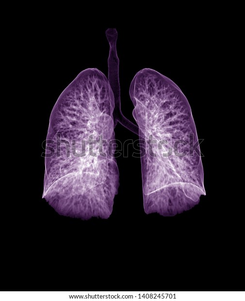 Ct Chest Lung 3d Rendering Image Stock Illustration 1408245701 ...