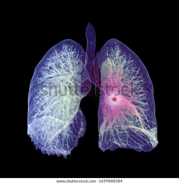 Ct Chest Lung 3d Rendering Image Stock Illustration 1699888384 ...