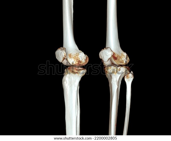 Ct Scan Knee 3d Rendering Image Stock Illustration 2200002805 ...
