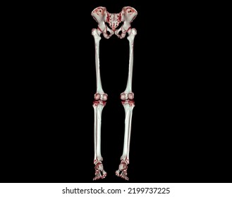 Ct Scan Lower Extremity 3d Diagnosis Stock Illustration 2199737225 ...