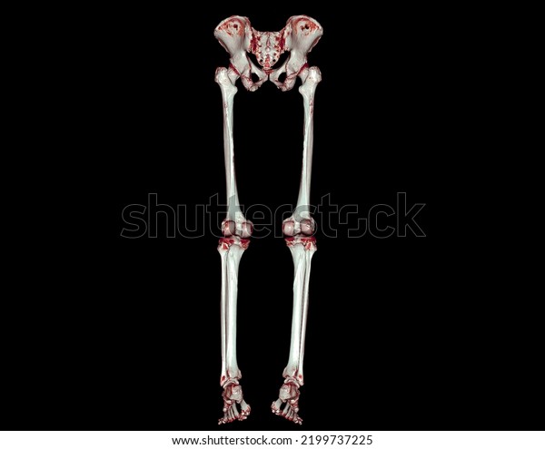 Ct Scan Lower Extremity 3d Diagnosis: ภาพประกอบสต็อก 2199737225 ...