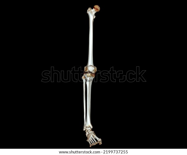 Ct Scan Lower Extremity 3d Diagnosis Stock Illustration 2199737255 ...