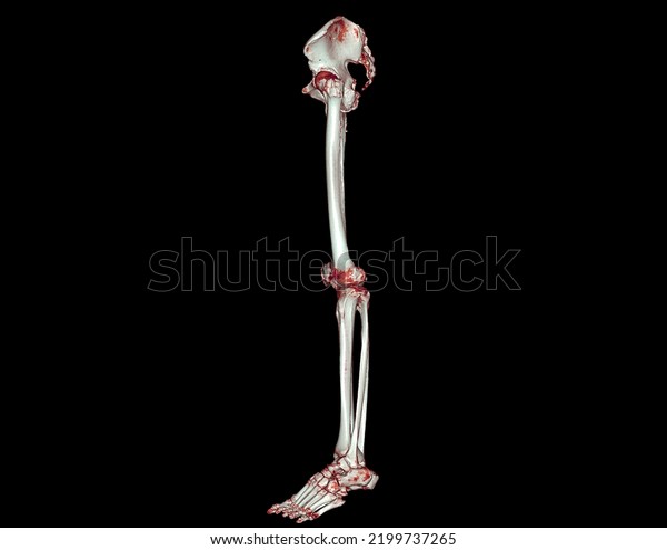 Ct Scan Lower Extremity 3d Diagnosis Stock Illustration 2199737265 ...