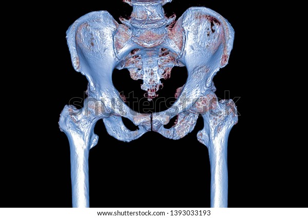 Ct Scan Pelvic Bone Both Hip Stock Illustration 1393033193 | Shutterstock