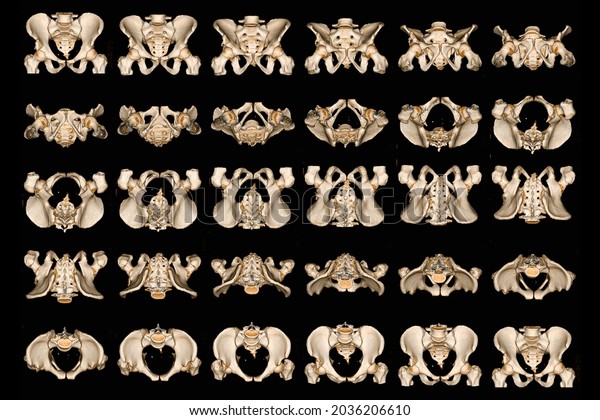 Ct Scan Pelvic Bone Both Hip 库存插图 2036206610 | Shutterstock