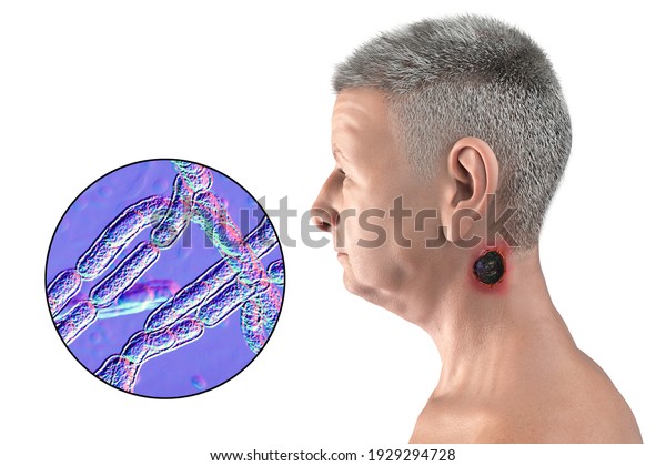 Cutaneous Anthrax Most Common Form Anthrax Stock Illustration ...