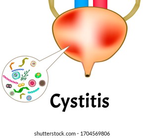 Cystitis Inflammation Bladder Structure Kidneys Bladder Stock ...