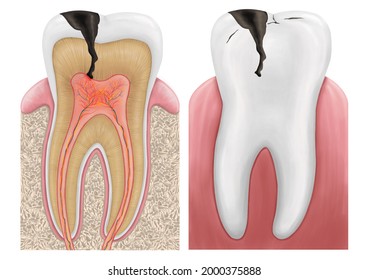 Decayed Tooth Illustration Tooth Caries Structure Stock Illustration ...