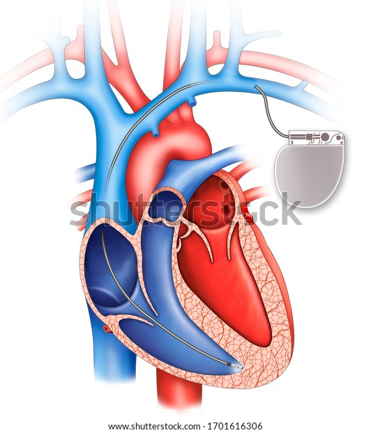 Descriptive Schematic Illustration Human Heart Pacemaker Stock ...