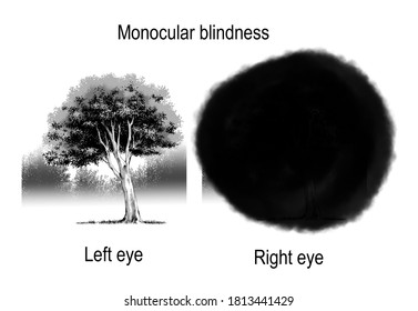 Different Patterns Visual Field Defects Neurological Stock Illustration ...