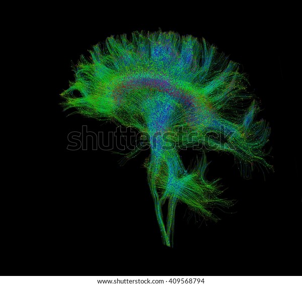 Diffusion Mri Referred Diffusion Tensor Imaging Stock Illustration ...