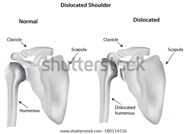 Dislocated Shoulder Diagram Stock Illustration 180114536