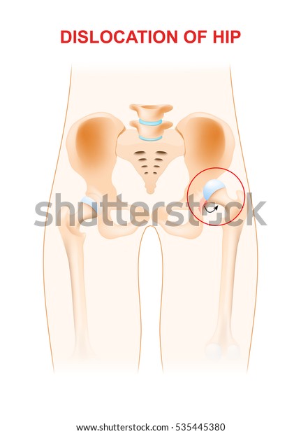 Dislocation Hip Hip Dislocation Takes Place Stock Illustration 535445380