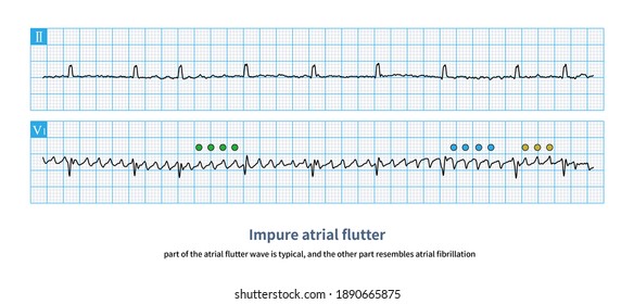During Atrial Flutter Part Atrial Flutter Stock Illustration 1890665875 ...