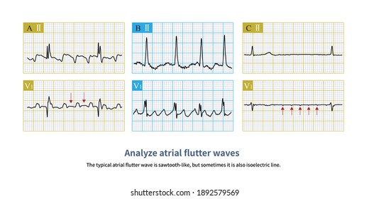 During Atrial Flutter Atrial Flutter Waves Stock Illustration ...
