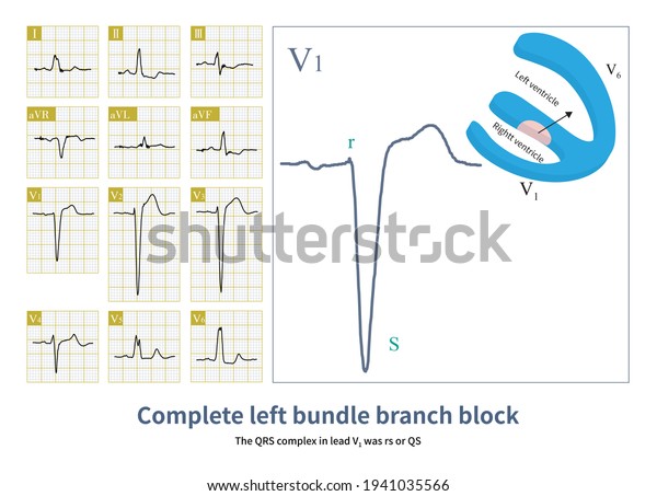 During Complete Left Bundle Branch Block Stock Illustration 1941035566 ...