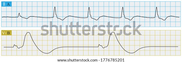 Dying Ecg Including Electromechanical Separation Slow Stock ...