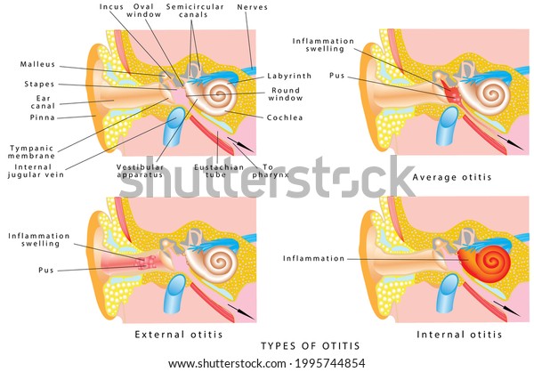 Otitis ocular. Tipos de otitis - otitis externa, media e interna ...