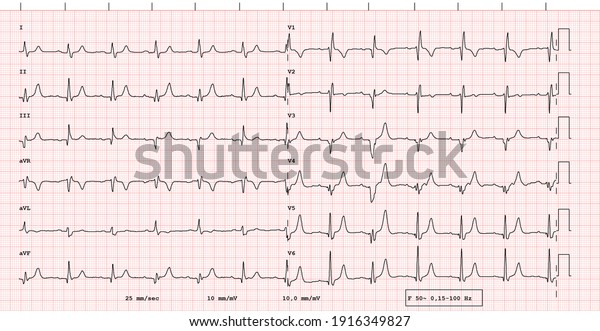 68 12 Lead Ecg Images, Stock Photos & Vectors | Shutterstock