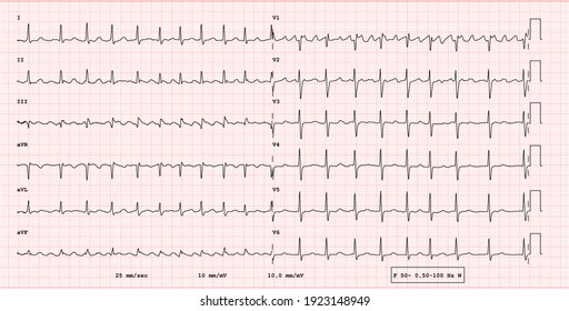 Ecg Example Pathological 12lead Rhythm Atrial Stock Illustration ...
