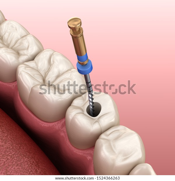 Endodontic root canal treatment process. Medically accurate tooth 3D ...
