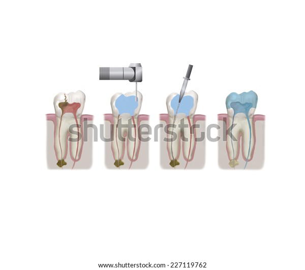 Endodontics Stock Illustration 227119762 | Shutterstock